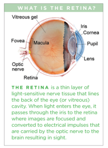 Macular Hole – San Diego Retina Associates